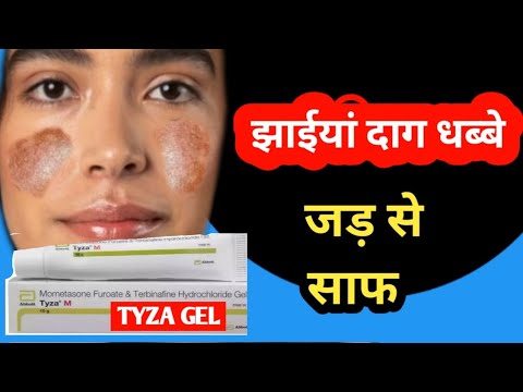 पुरानी से पुरानी झाईया दाग धब्बे साफ करे | tyza m gel uses in hindi ...