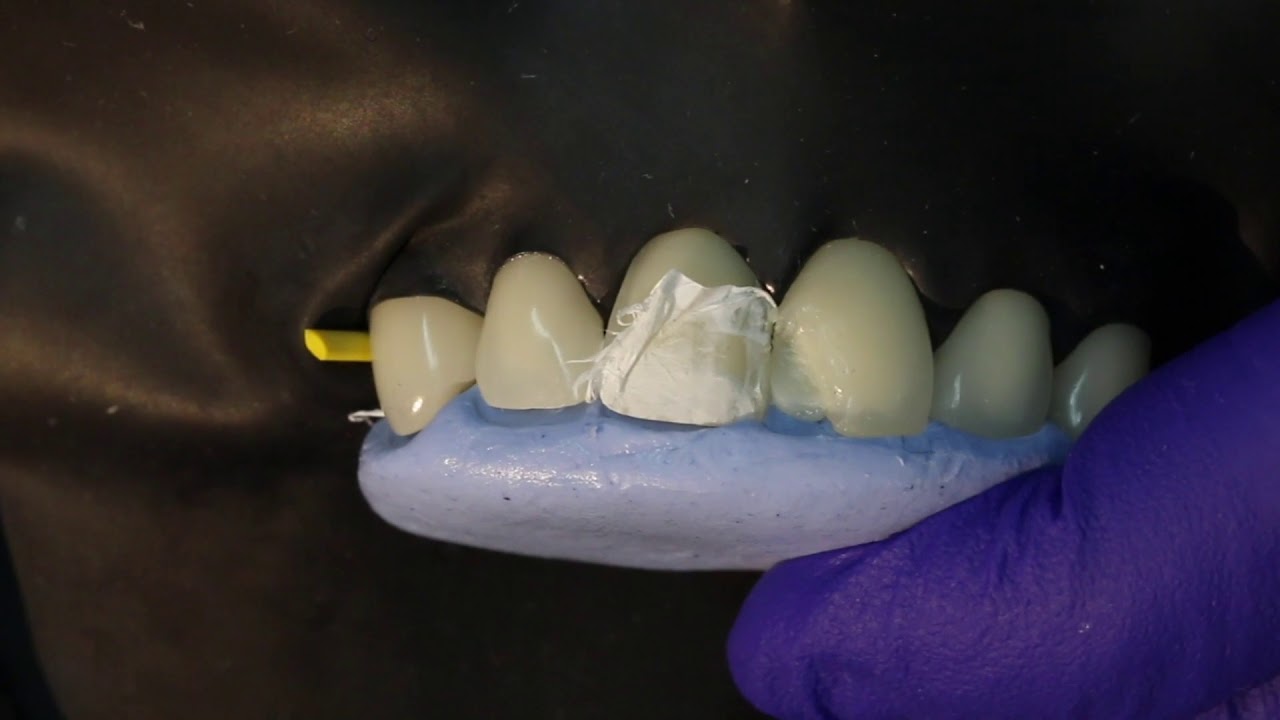 New composite Ceram.x Spectra ST CLOUD shade concept - YouTube
