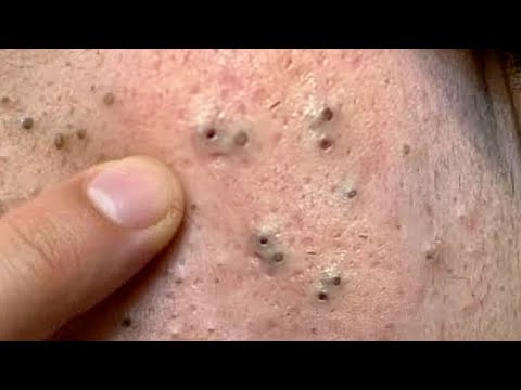 sac be spa blackheads elderly old men face | sac be spa men face blackhead 2026 | Step by Step #446