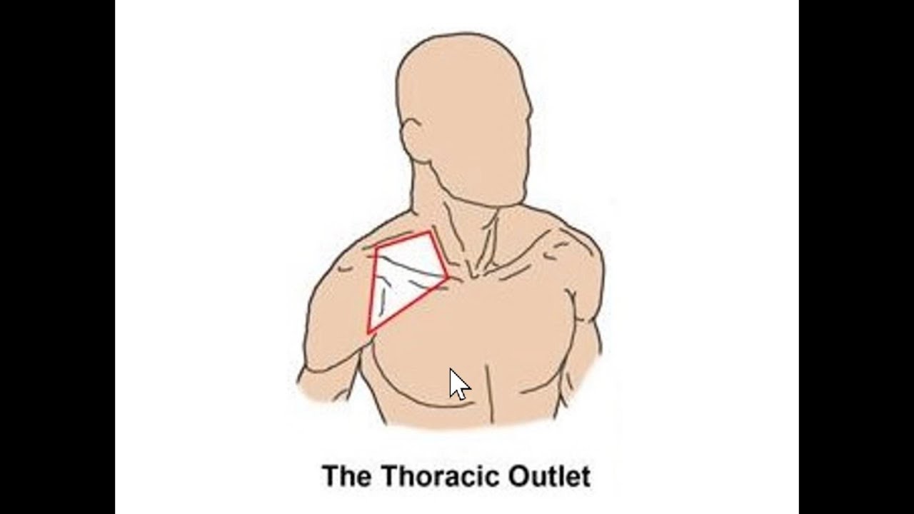 What is Thoracic Outlet Syndrome (TOS) ? - YouTube