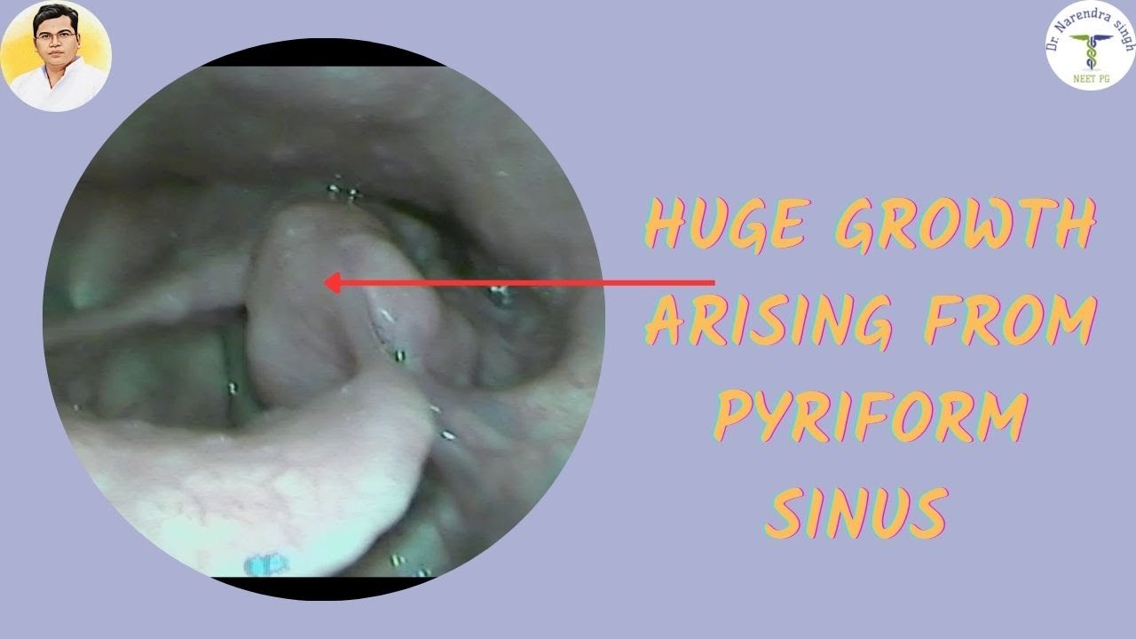 HUGE CANCER ARISING FROM PYRIFORM SINUS - YouTube