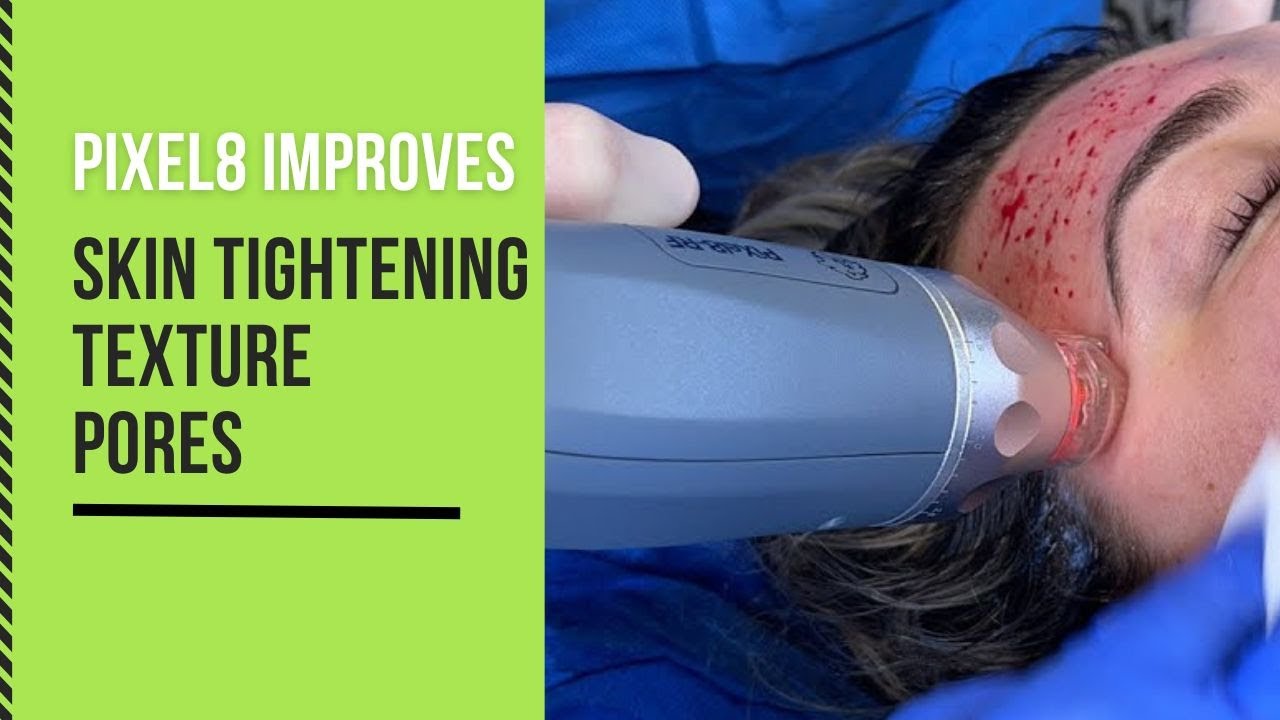 DEEP MICRONEEDLING RF WITH PIXEL8 IMPROVES SKIN TIGHTENING, TEXTURE ...