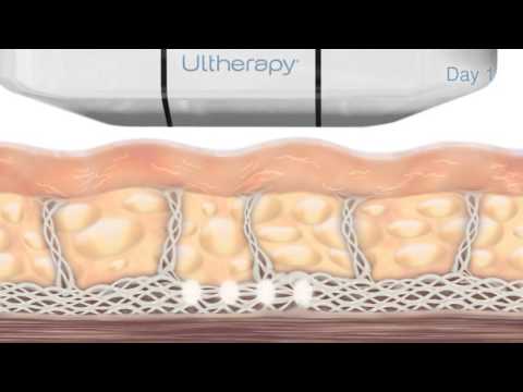 Animation of How Ultherapy Works - YouTube