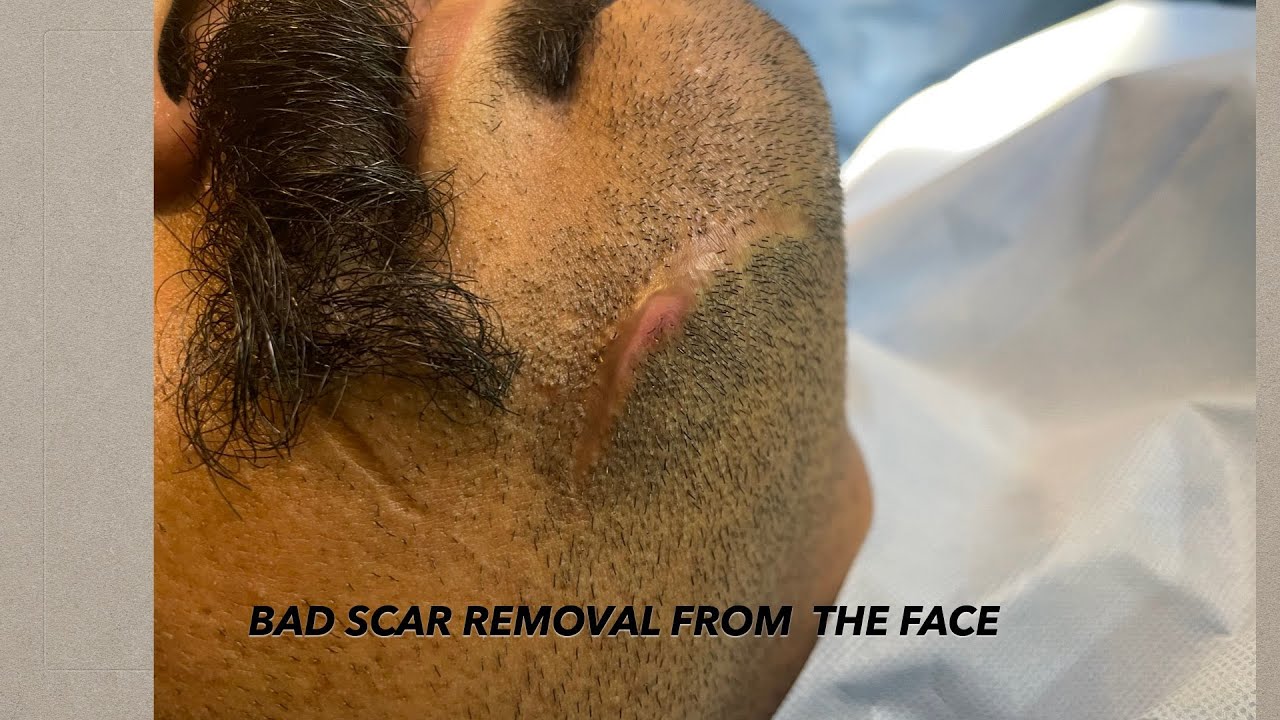 How To Get Rid of Scars? Best Scar Removal Surgery in Kerala with PRP ...