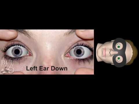 Right Horizontal Canal BPV (Benign Positional Vertigo) - YouTube