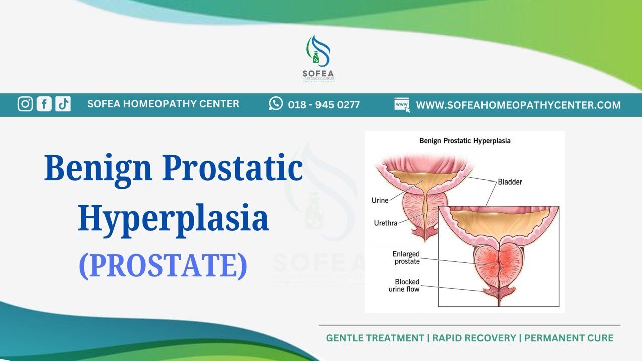 Benign Prostatic Hyperplasia - YouTube