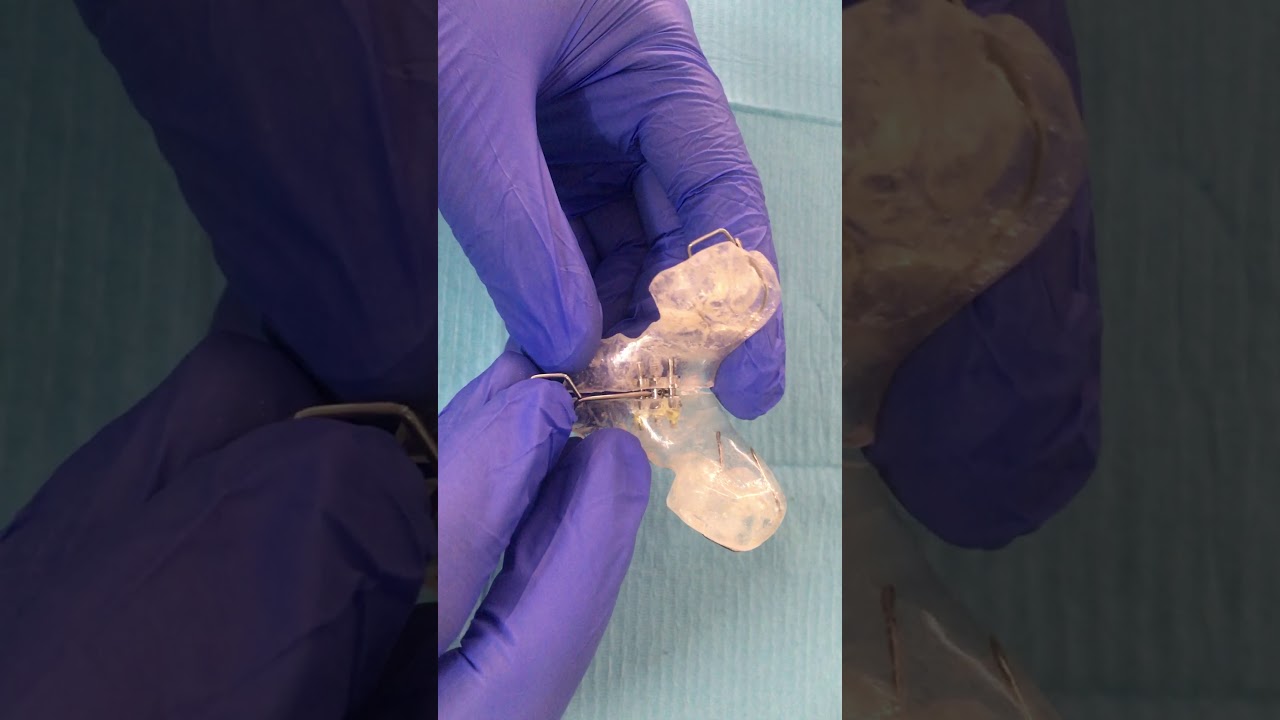 Expansion screw activation in Orthodontics@Faces n Smiles Chandigarh ...