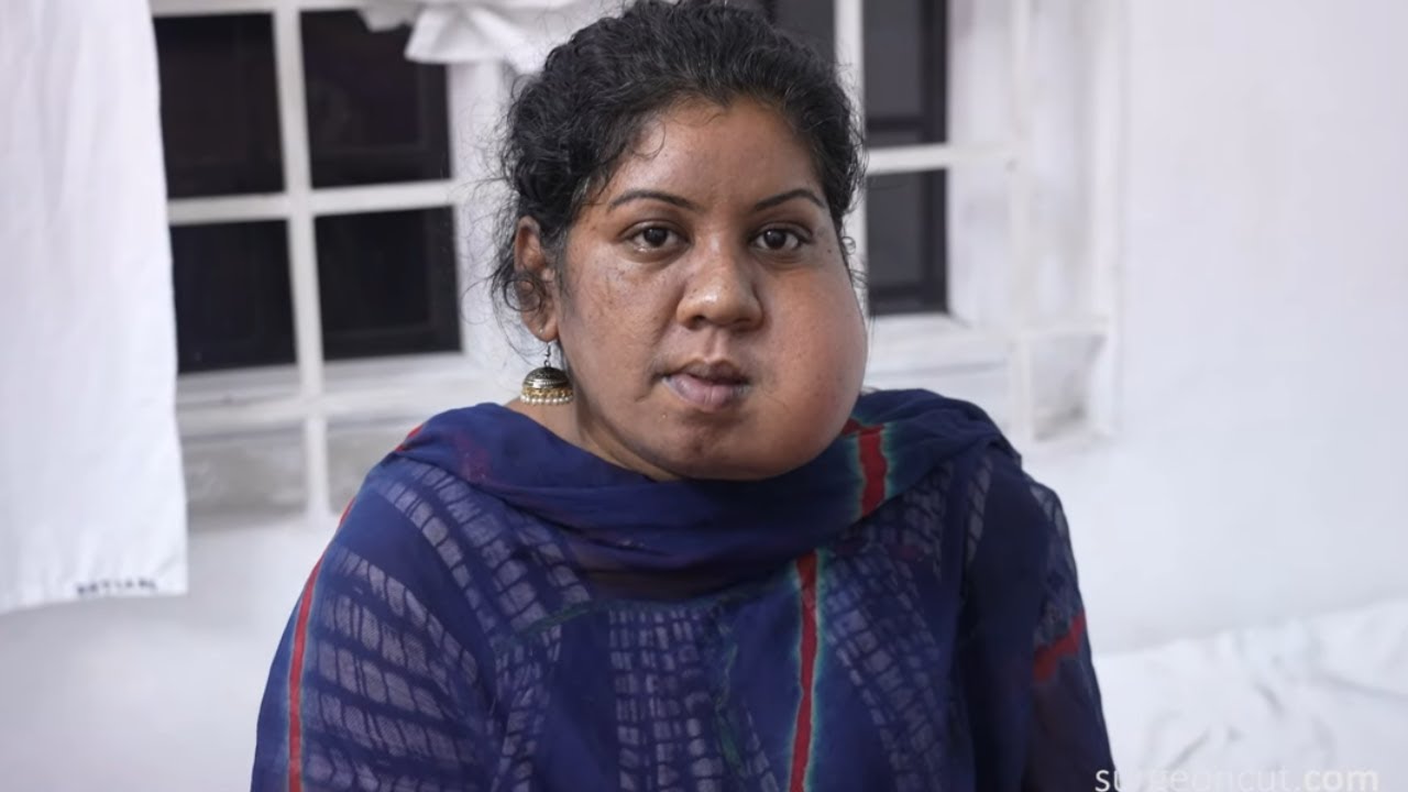 Face Tumor Removal for a Woman - Complete Procedure - YouTube