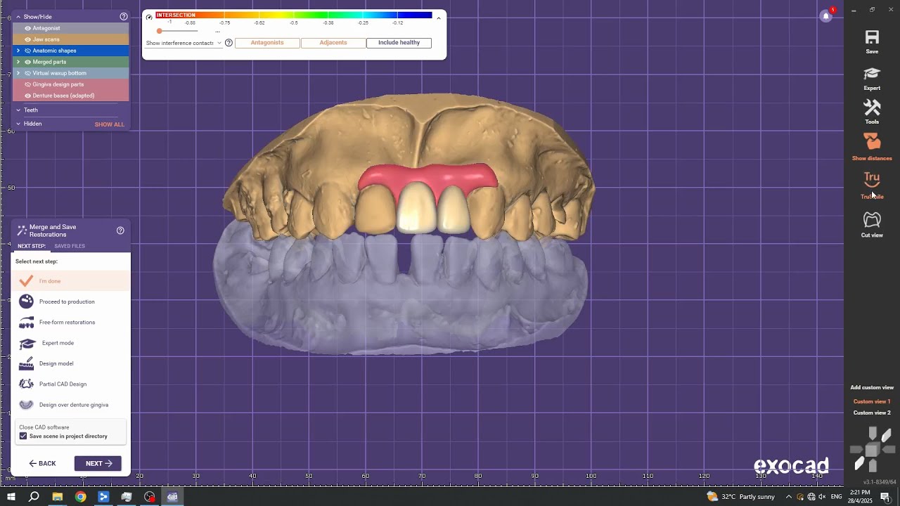 Exocad Flexible Denture Design For Upper Arch (2 Teeth) - YouTube