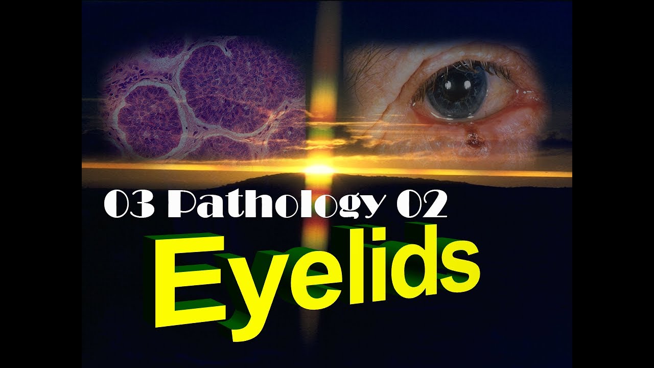 03 Malignant lid tumors part-02 #Elkafrawy #pathology #باثولوجي # ...