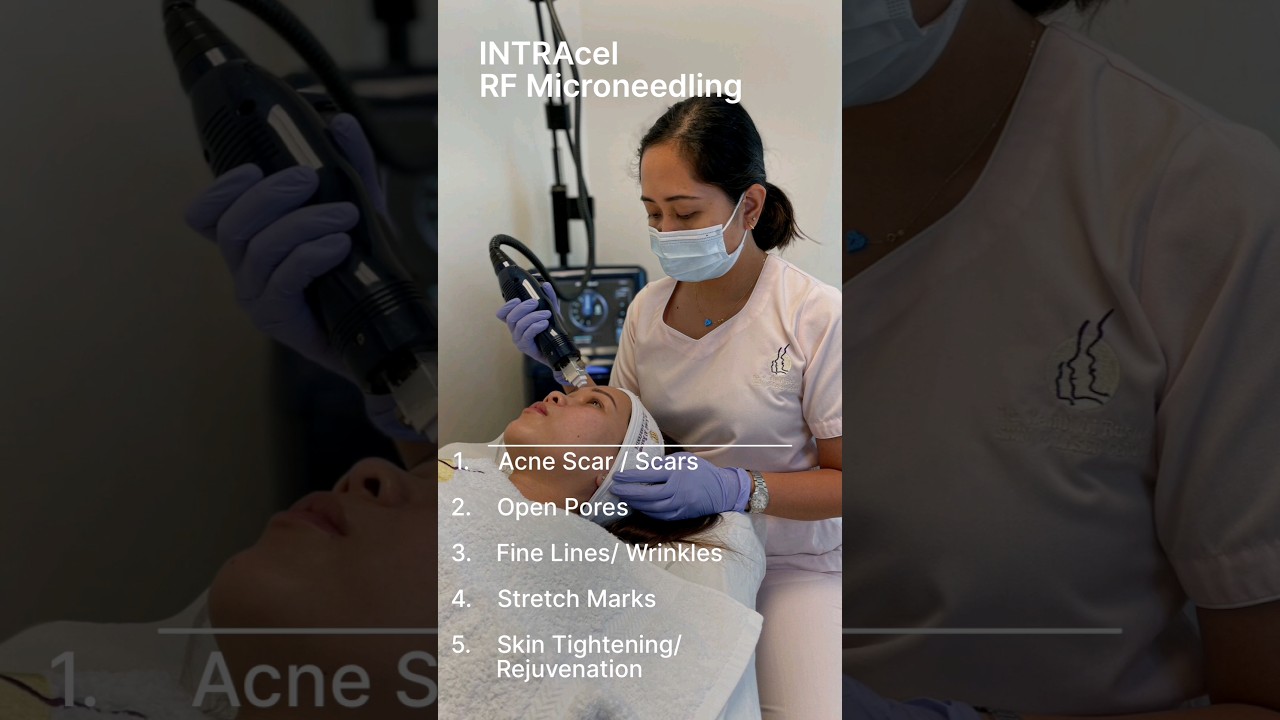 Intracel RF Microneedling Use - YouTube