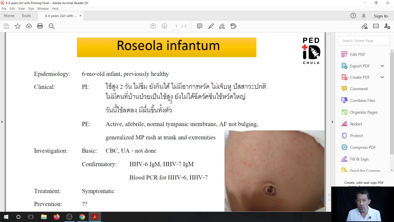 Mini lecture 30 Case demonstration Roseola infantum - YouTube