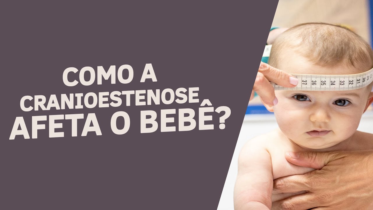 Cranioestenose em Bebê: Como identificar a Deformidade do Crânio - YouTube