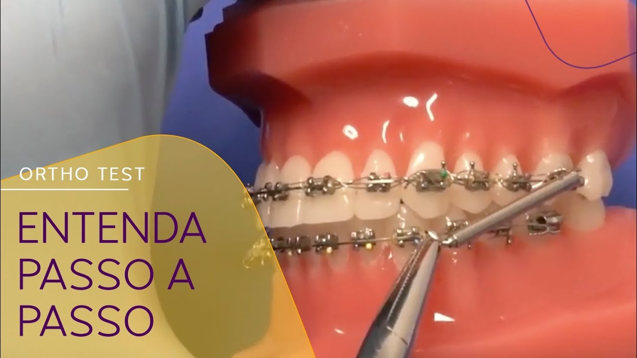 Instalação do Propulsor Mandibular GoToOne da Leone| APM - YouTube