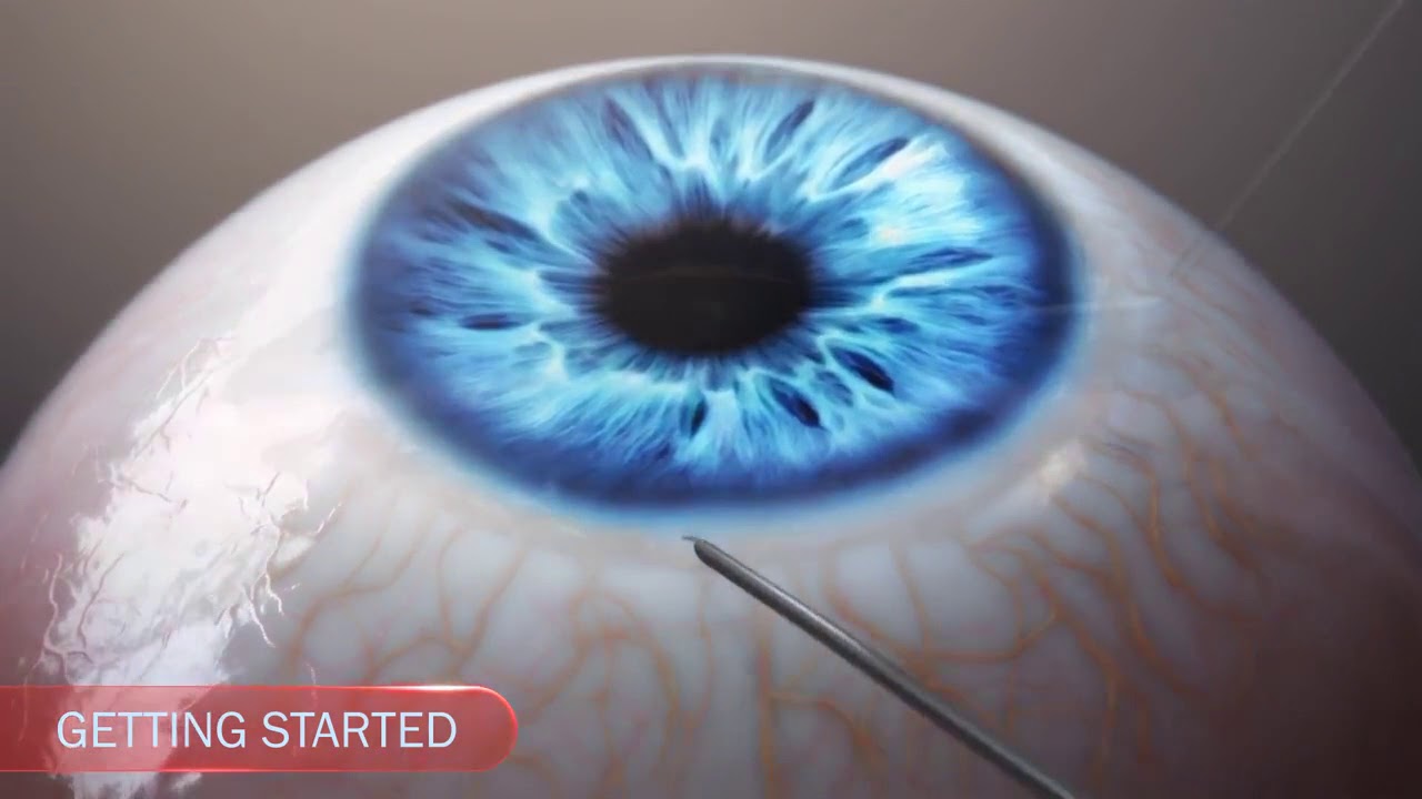 Glaucoma canaloplasty schematic video - YouTube