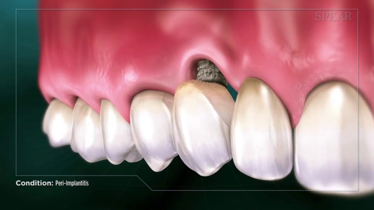 Peri-implantitis - Dental Implant Infection - YouTube