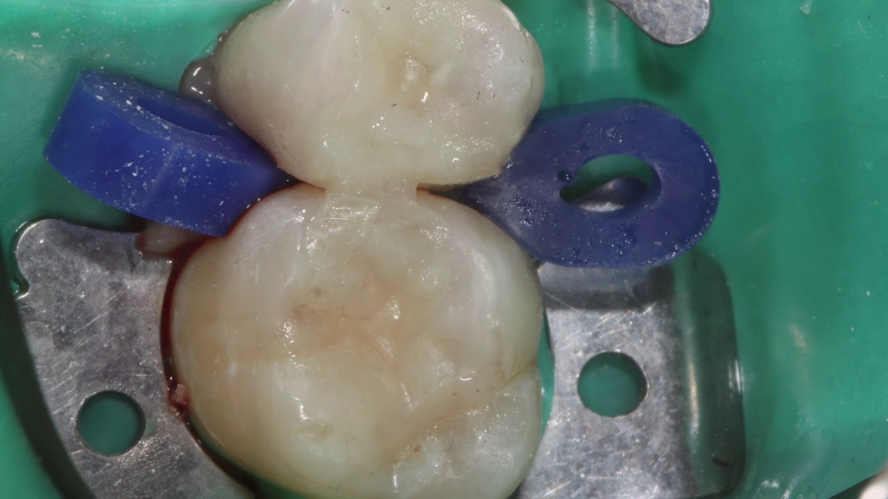 A Clear Polyvinyl siloxane Technique for the Placement of Posterior ...