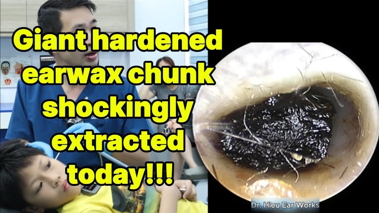 Giant hardened earwax chunk shockingly extracted | ear cleaning | ASMR ...