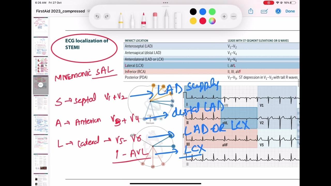 ECG localization of Mi #cardiology 88 | First Aid USMLE Step 1 in Urdu ...