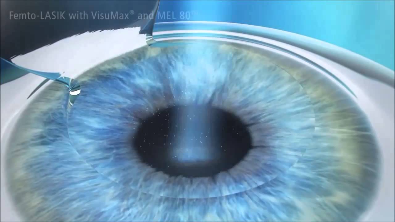 Operazione Laser Lasik & VisMax - Oftalmologianews.com - YouTube