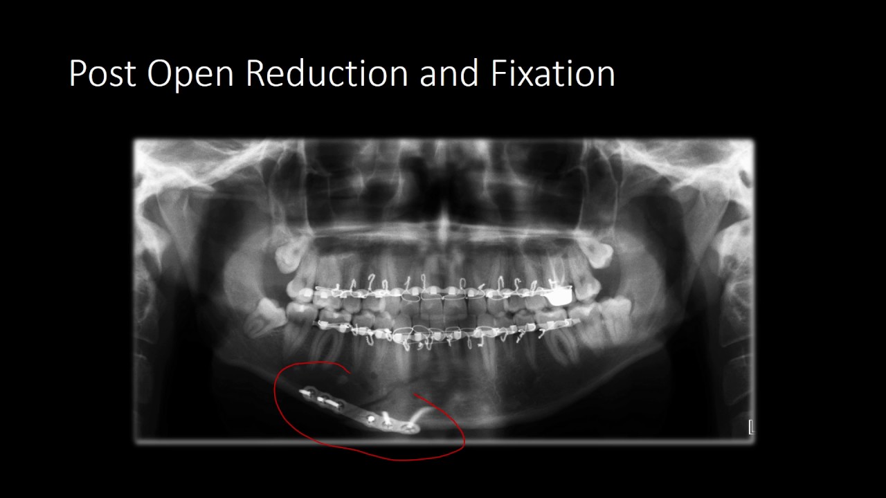 Treatment of right parasymphysis and left subcondylar fractures - YouTube