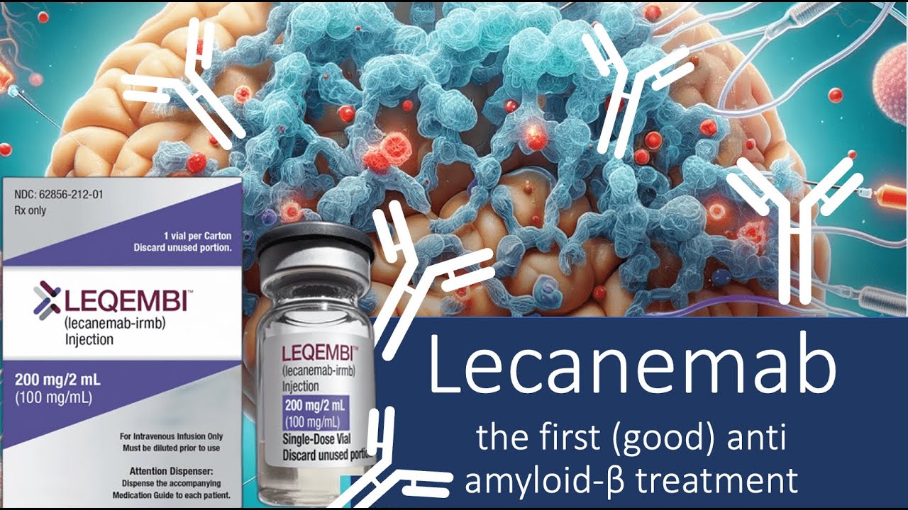 Lecanemab and the new potential of anti-abeta therapies for Alzheimer's ...