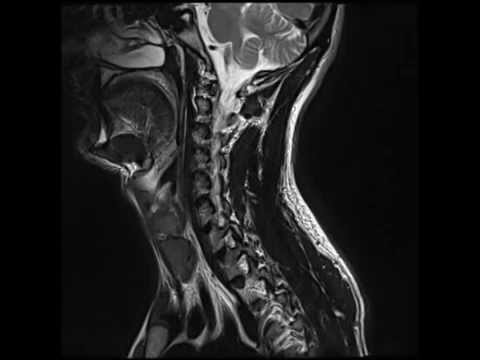 MRI - Incomplete T7 Spinal Cord Injury - YouTube