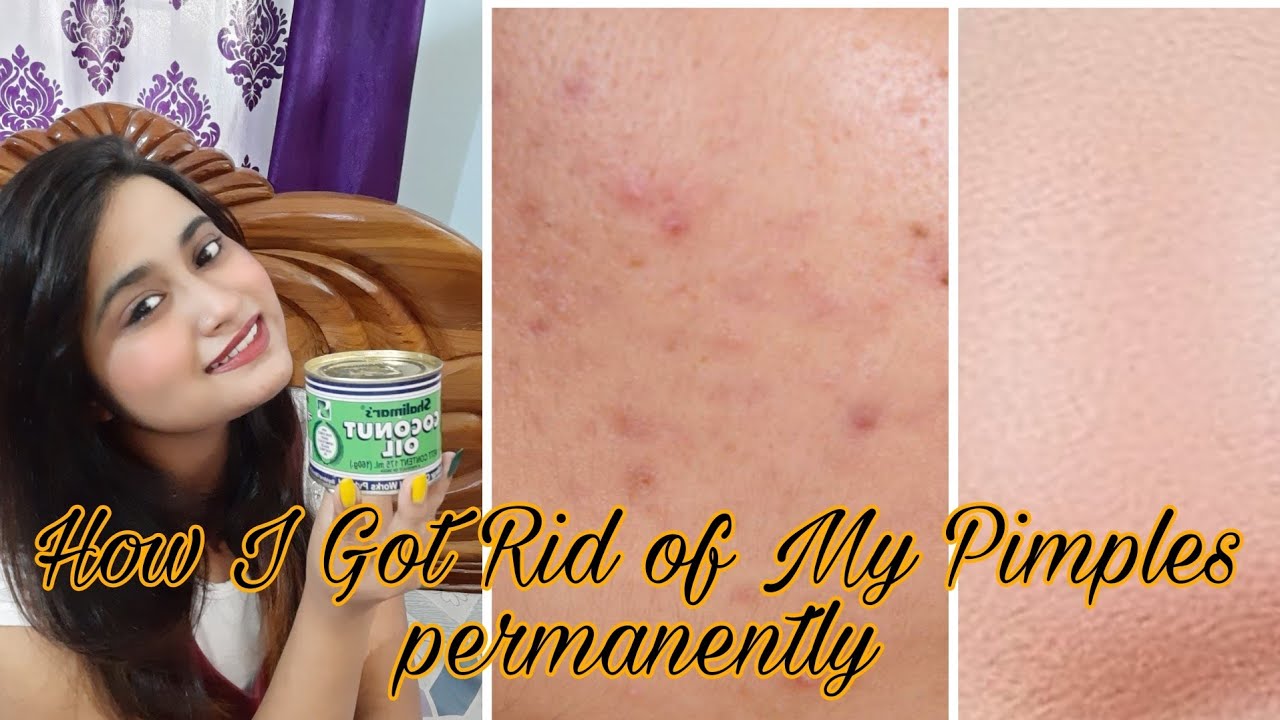 How to Remove pimples,Acne,pimple Marks completely|| coconut oil|| # ...