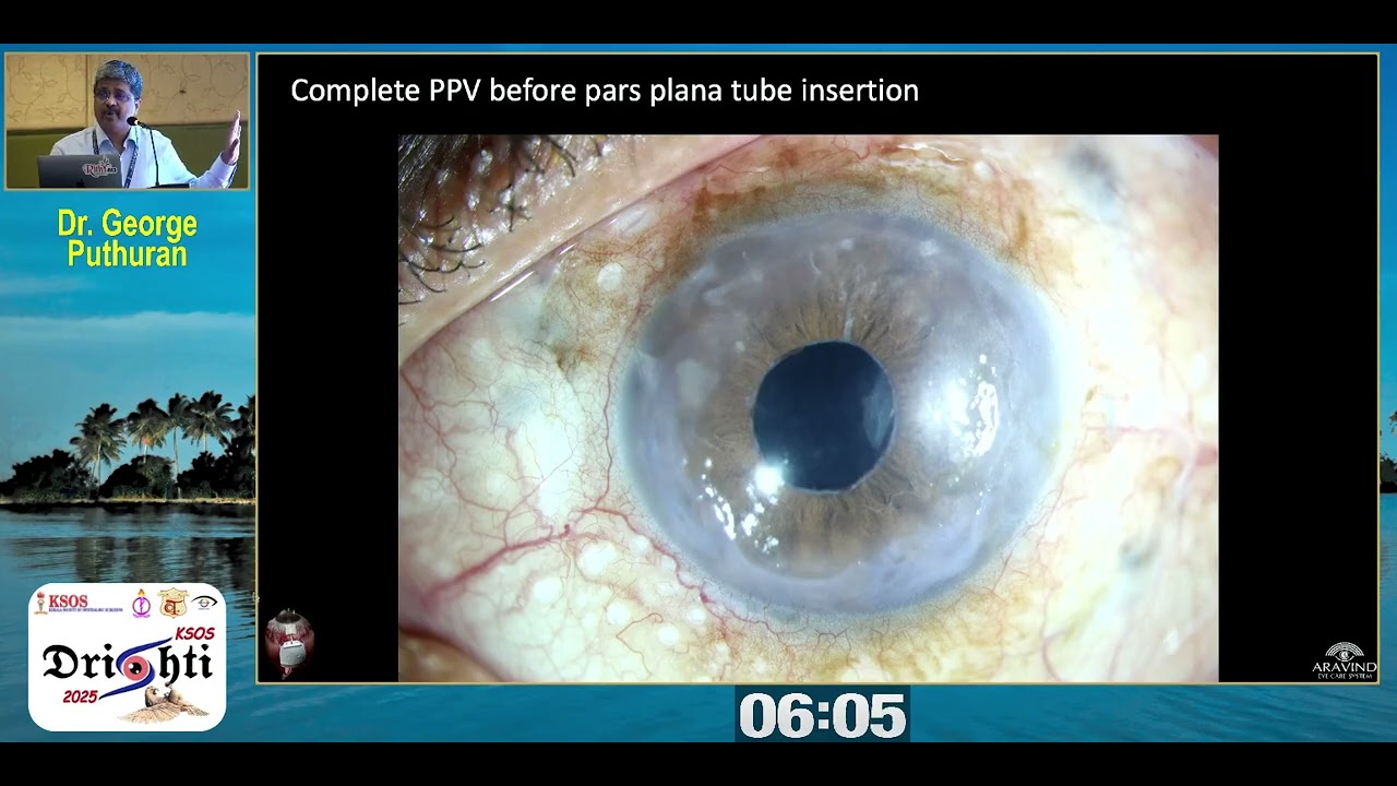 KSOS 2025 IC33 T Dr George Puthuran Intra and postoperative challenges ...