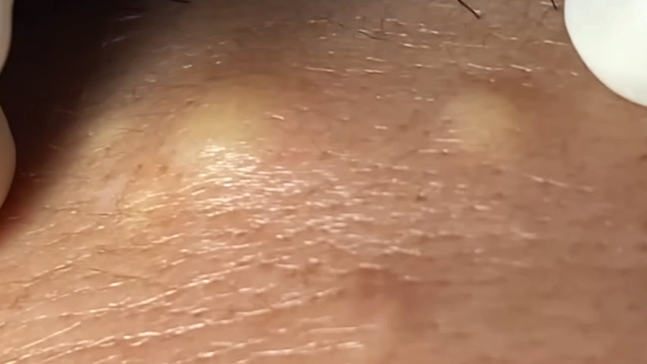 "Satisfying Blackhead & Whitehead Removal! 😲 Pimple Popping | Acne ...