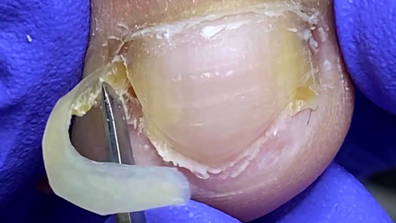 The hook grows at the root of the nail, it looks very deep!【Doctor Liu ...