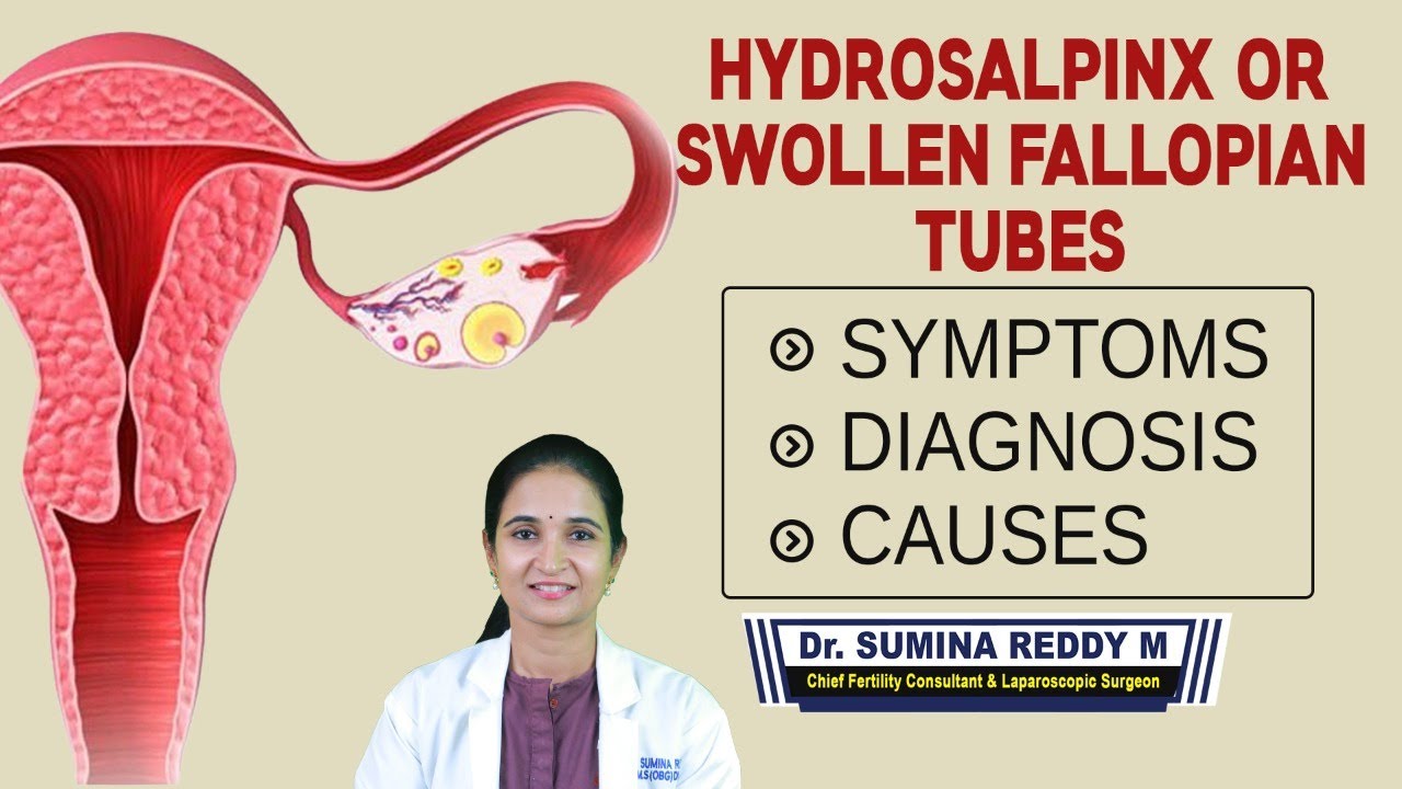 Hydrosalpinx: Symptoms, Diagnosis, Causes, Treatment | Dr Sumina Reddy ...