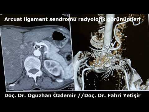 Arcuat ligamend sendromu radyolojik görüntüleri