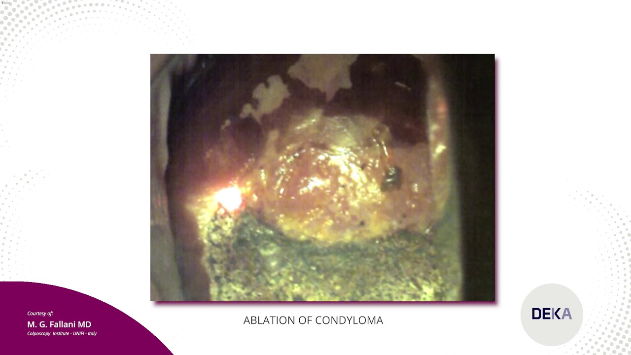 COLPOSCOPY - Endocervical HSIL CIN II - YouTube