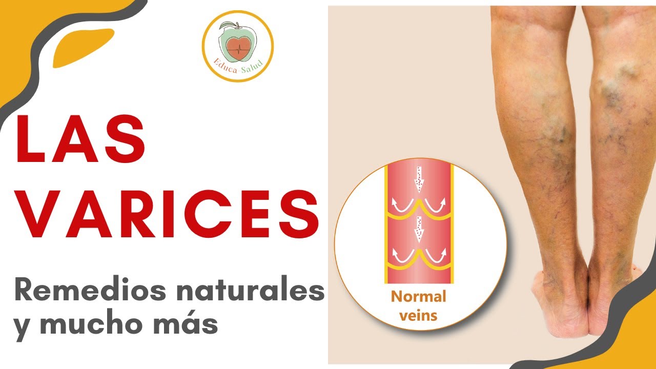 CÓMO ELIMINAR LAS VARICES: Remedios - YouTube