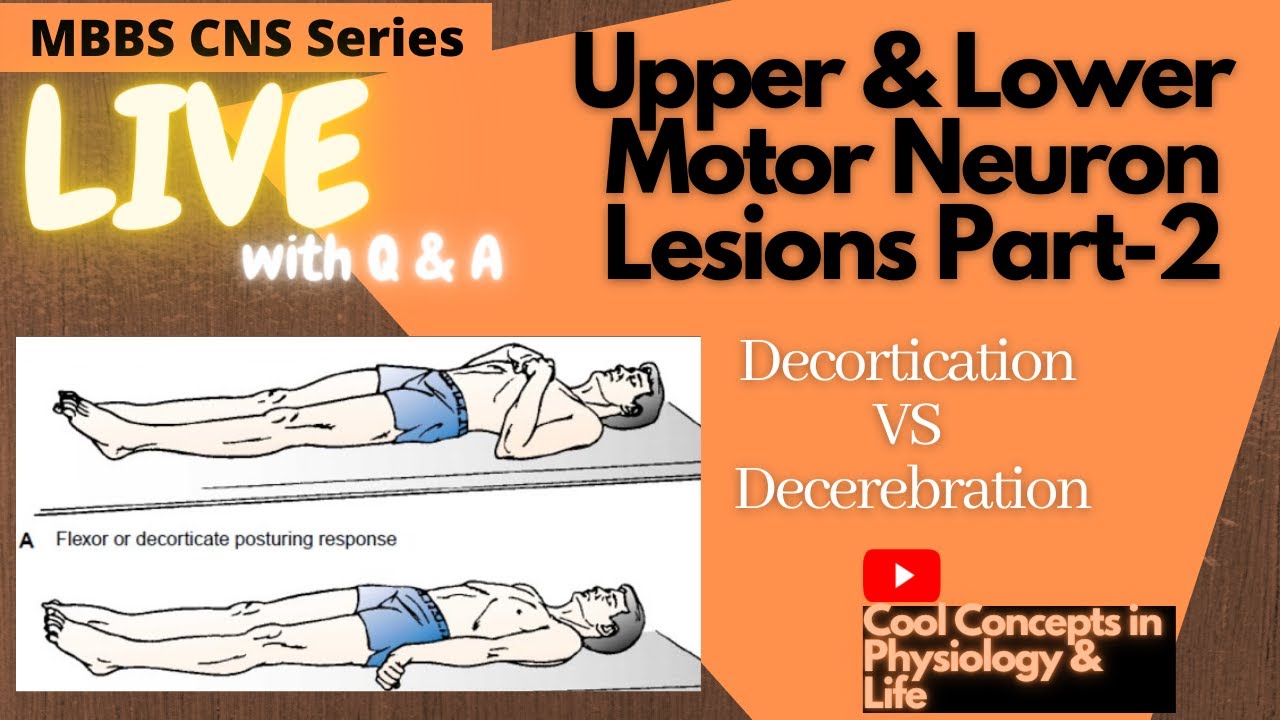 7d. LIVE: Upper & Lower motor neuron lesions Part-2 | Decortication VS ...