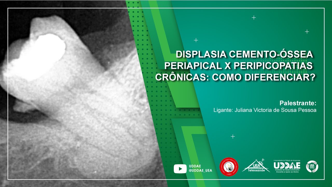 Displasia cemento-óssea periapical X peripicopatias crônicas: como diferenciar? - YouTube