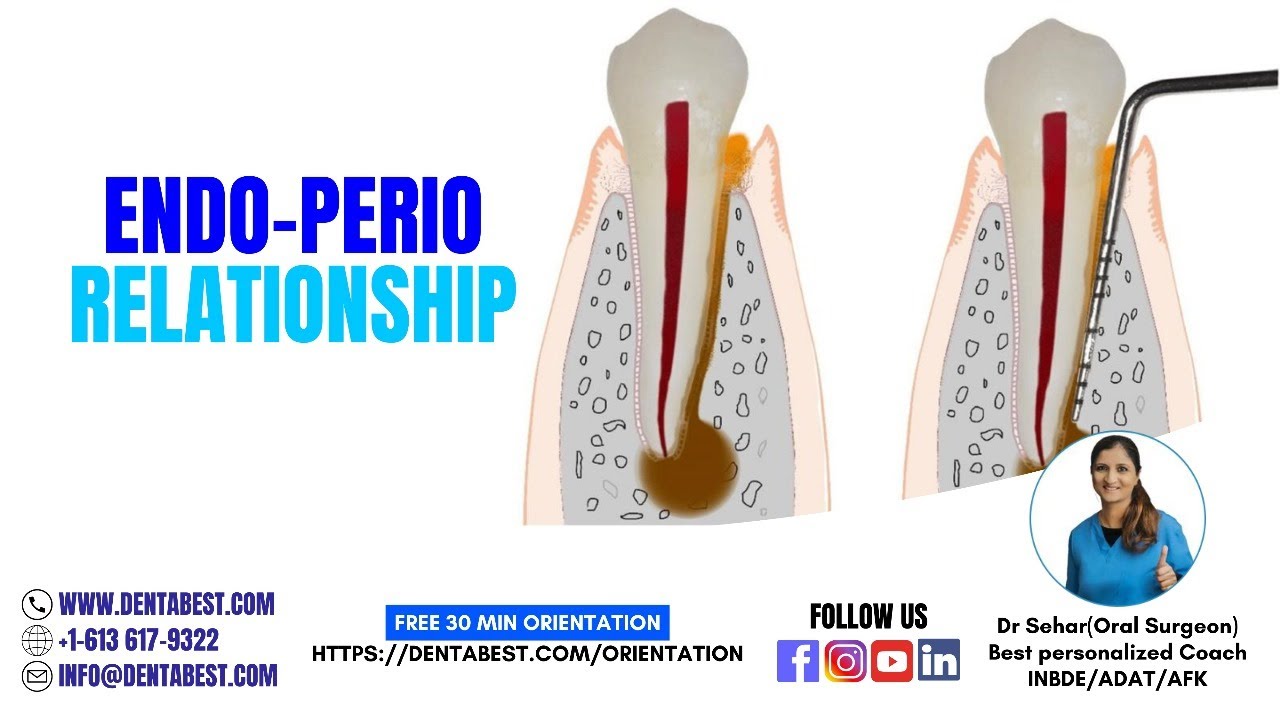 Exploring the Endo-Perio Relationship / Diagnosis and Treatment ...