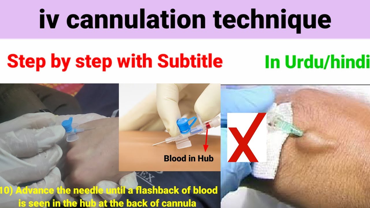 iv cannulation technique /cannula lagane ka sahi tarika #ivcannula #cannulation - YouTube
