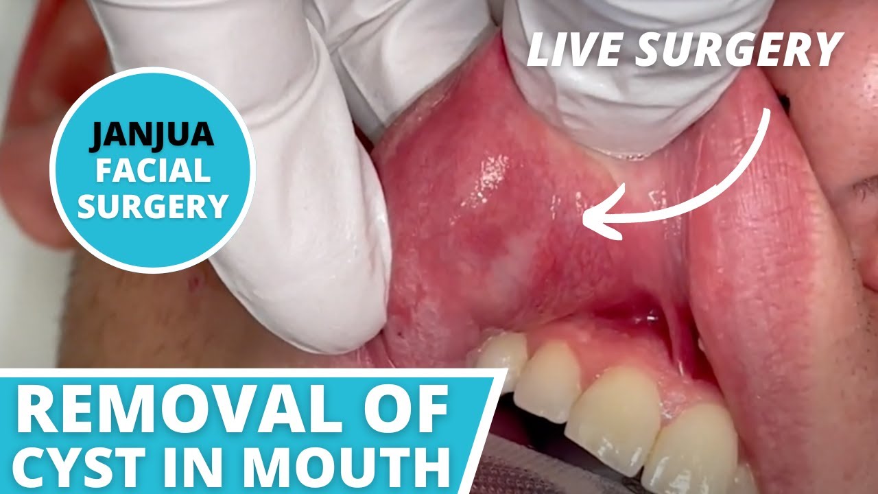 REMOVAL OF CYST IN MOUTH LIVE SURGERY DR TANVEER JANJUA NEW removal-of-cyst-in-mouth-live-surgery-dr-tanveer-janjua-new