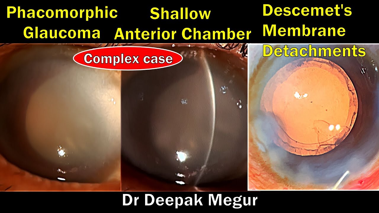 Lens Induced Glaucoma, Phacoemulsification. Small Descemet's Membrane ...