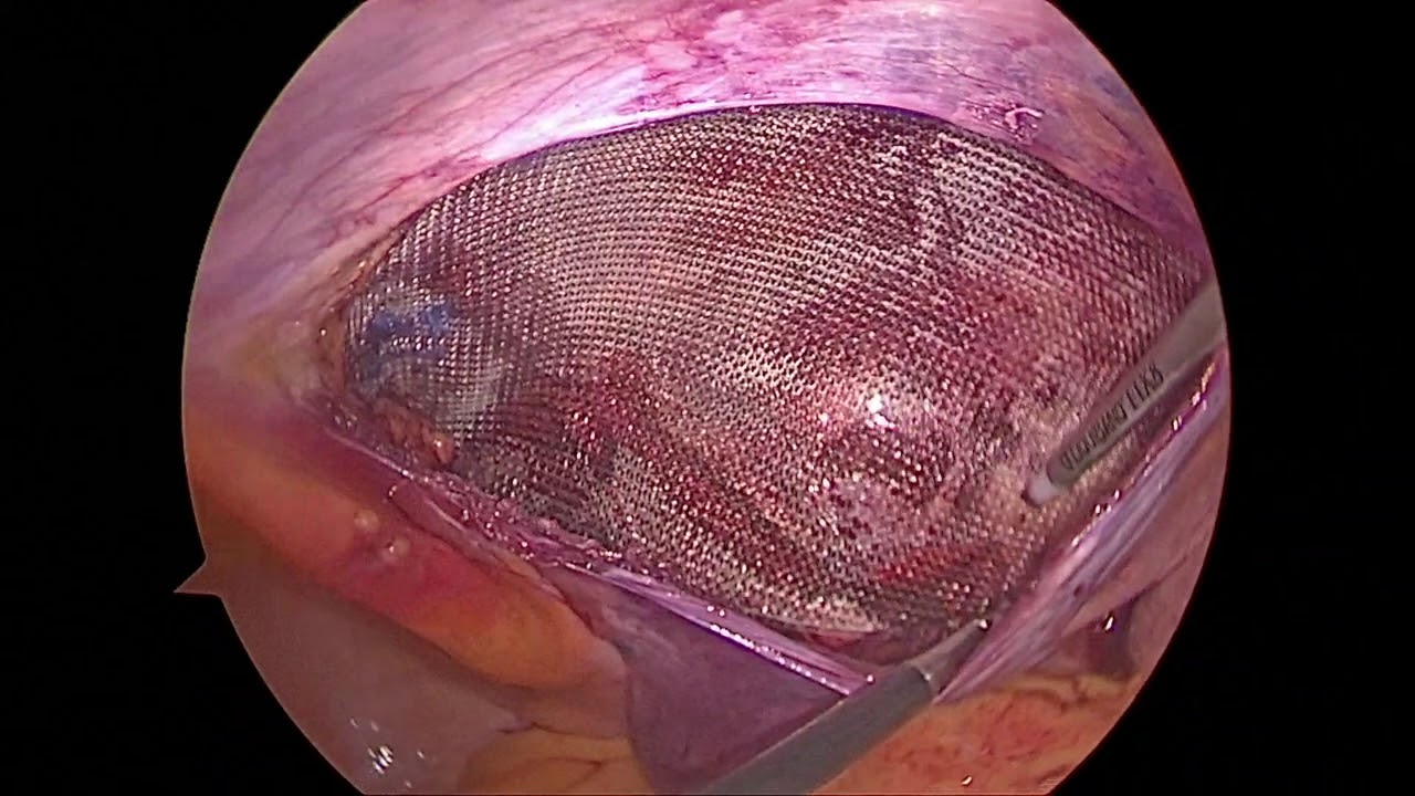 TAPP mesh placement and closure with glue - YouTube