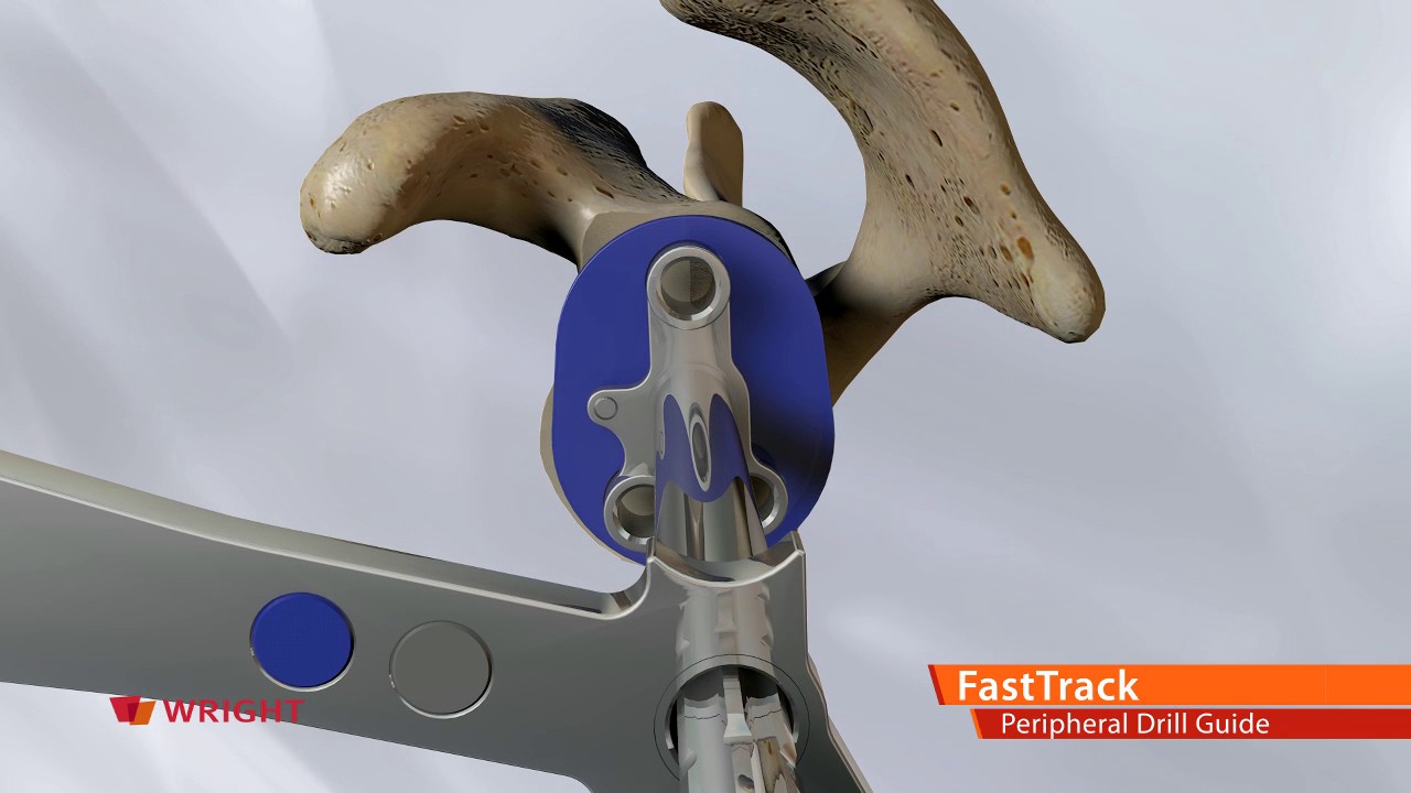 AEQUALIS™ PERFORM™+ Shoulder System_FastTrack Peripheral Drill Guide ...