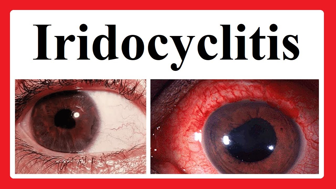 Iridocyclitis