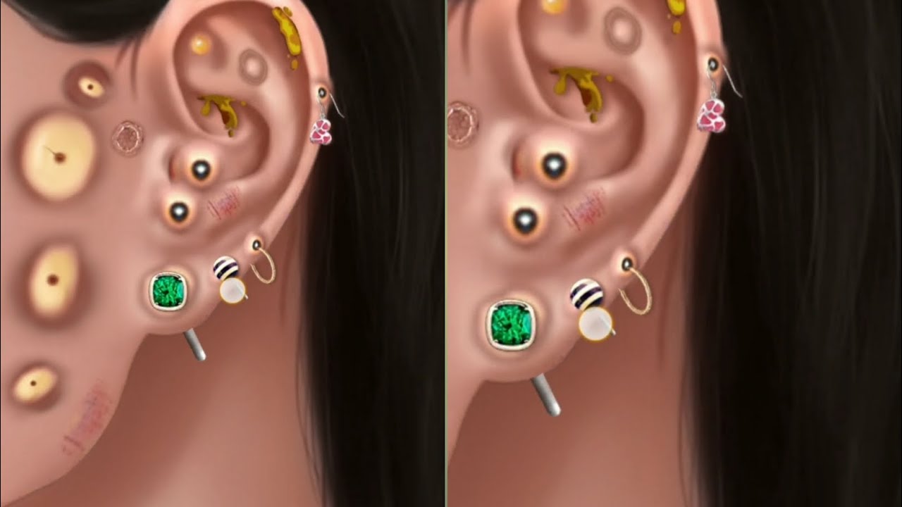ASMR satisfying ear cleaning therapy and remove pimples and blackheads ...