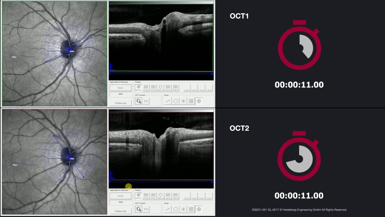 SPECTRALIS OCT1 vs. OCT2: Glaucoma – ONH Circle Scan - YouTube