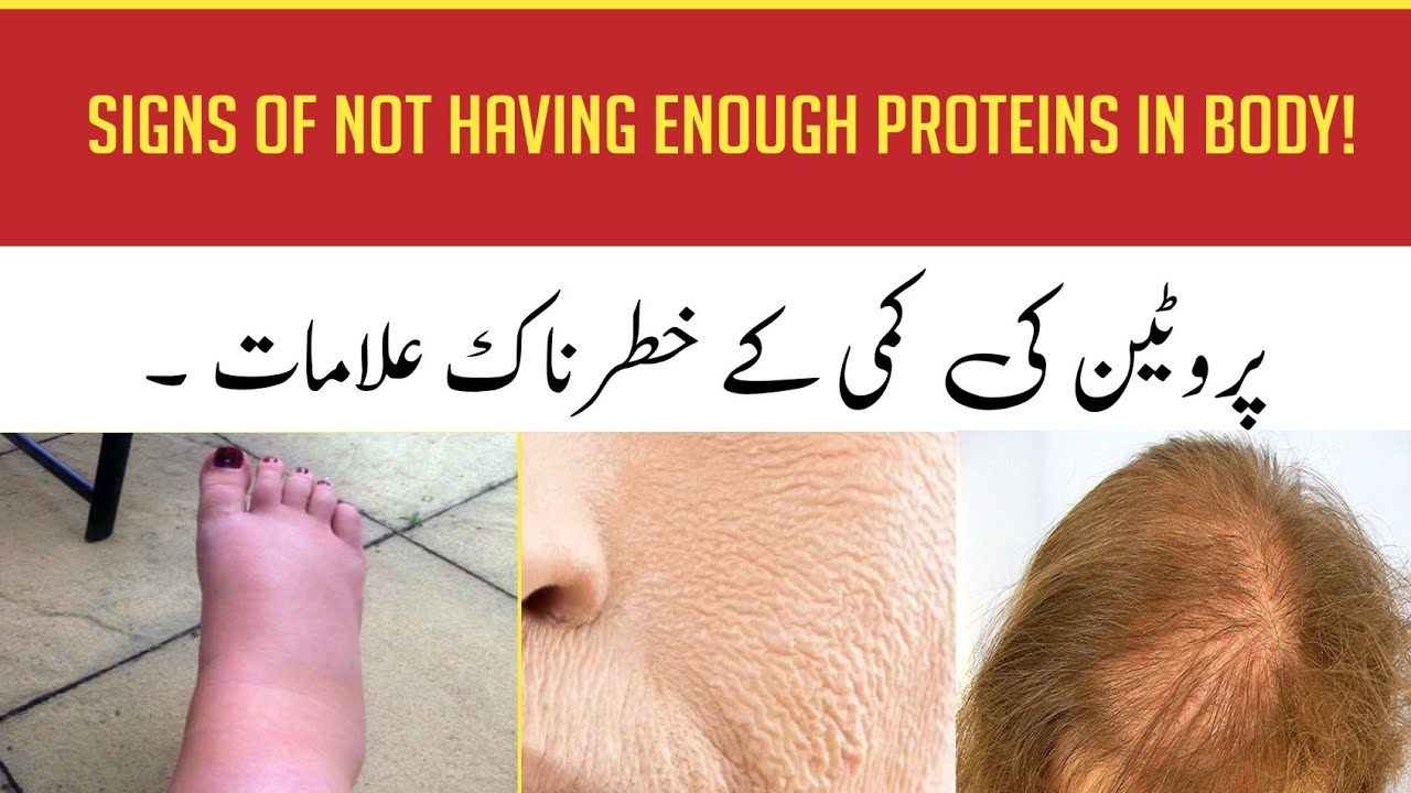 8 signs of not getting enough proteins || Proteins deficiency related ...