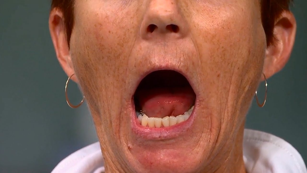 Patient with TD: Tongue Movement - YouTube