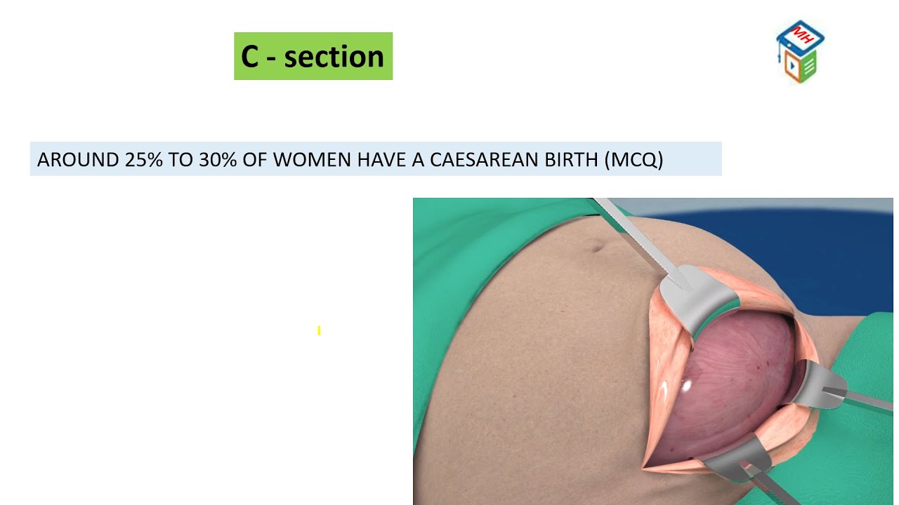 C-SECTION | INDICATIONS | PROCEDURE | RCOG Guidlines |MCQS | CPSP FORMAT |GYNAEOBS - YouTube