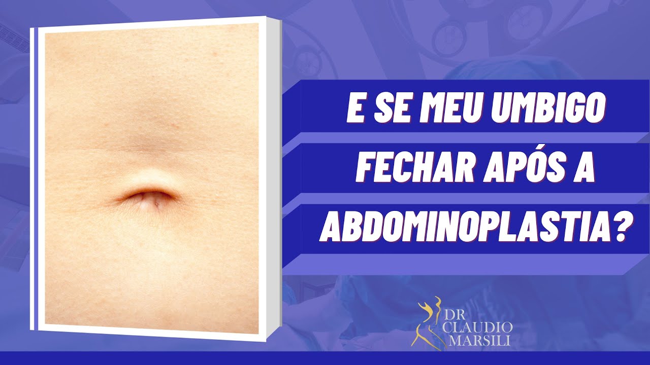 E se meu umbigo fechar após a Abdominoplastia? | Dr. Claudio Marsili ...